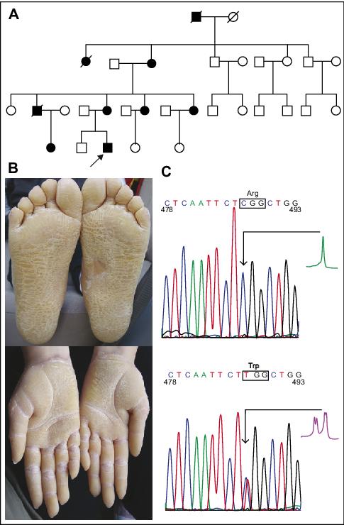 Six Generations Of Epidermolytic Palmoplantar Keratoderma 58 Off