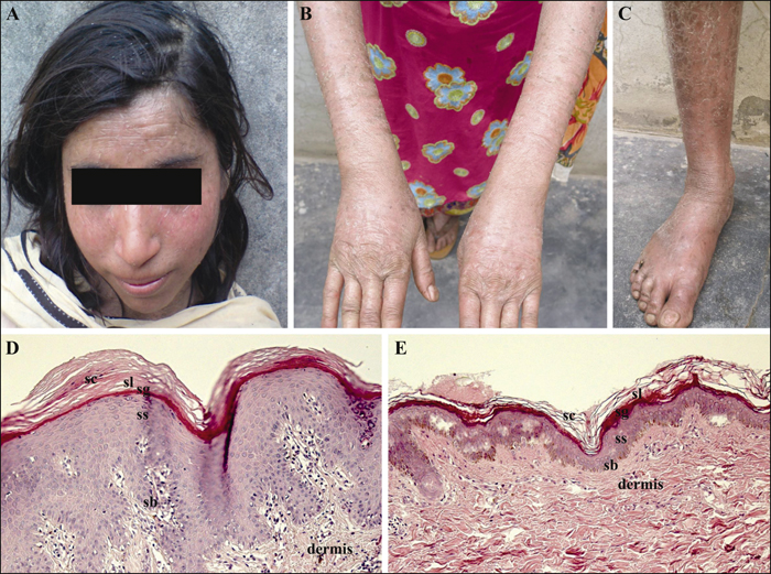 Congenital Ichthyosis Erythroderma