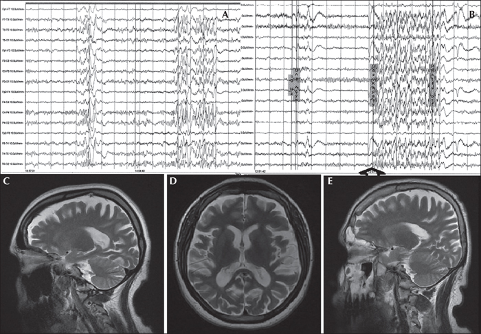 John Libbey Eurotext Epileptic Disorders Long Term Follow Up Of Two