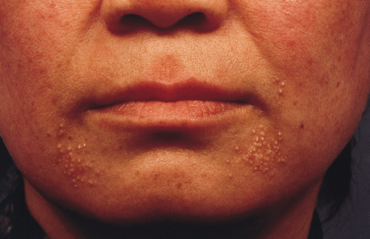 Milia Removal Around Lips