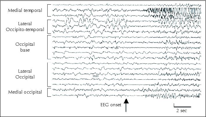 John Libbey Eurotext Epileptic Disorders Early Seizure Propagation