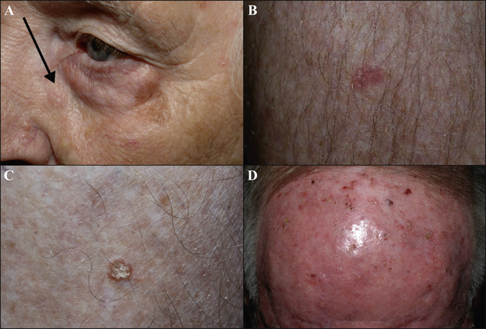 Actinic Keratosis Causes Symptoms Actinic Keratosis 48 Off