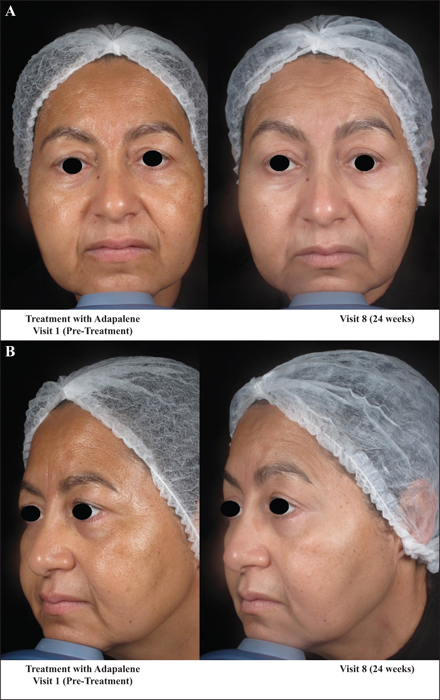 JLE European Journal of Dermatology Comparable efficacy of adapalene 0.3 gel and tretinoin 0.05 cream as treatment for cutaneous photoaging