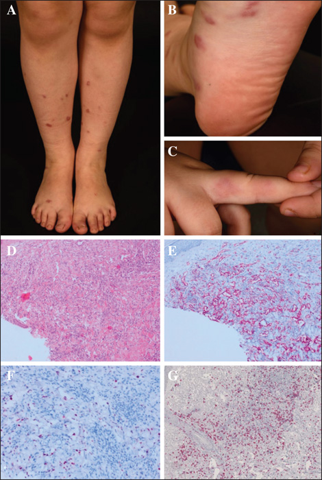 Jle European Journal Of Dermatology Disseminated Classic Kaposi Sarcoma In A Seven Year Old Girl