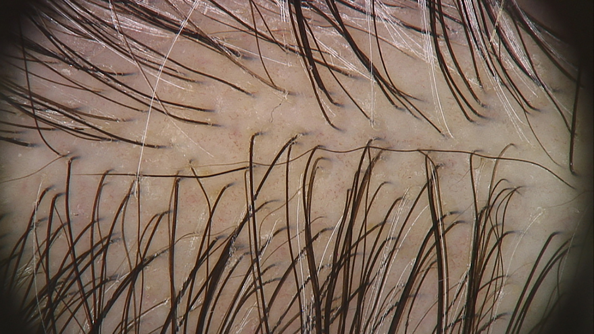 Jle European Journal Of Dermatology A Comprehensive Literature