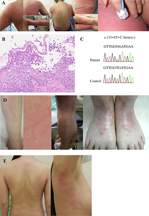 Jle European Journal Of Dermatology Erythema Multiforme After